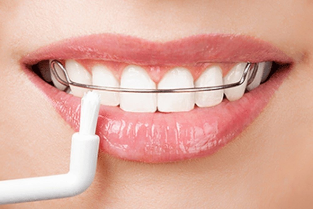Retainer Care Guide | Professional Orthodontist in Houston, TX